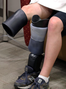 Addressing a Critical Problem Faced by Amputees With Prosthetic Limbs